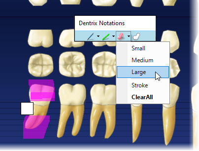 Making Visual Notations in the Patient Chart | The Dentrix Blog