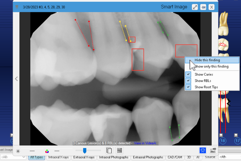 Focusing on Specific Detect AI Annotations | The Dentrix Blog