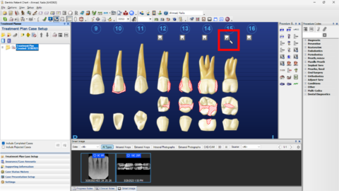 Accessing Dentrix Detect AI Images from Within the Patient Chart | The ...